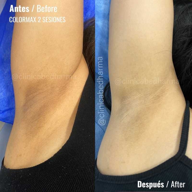 Aclarar axilas con Colormax - Clínica Estética en Medellín